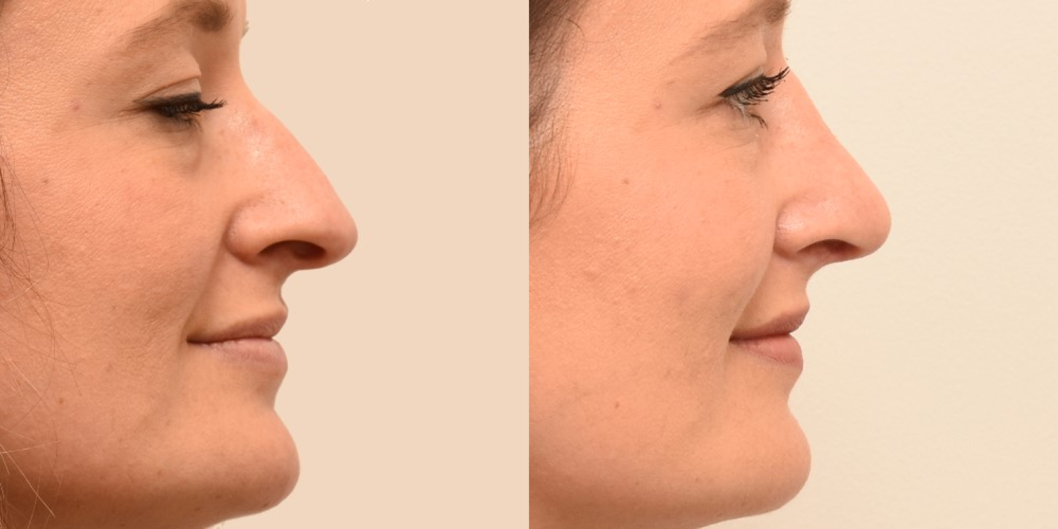 Oplossing voor Scheve neus – Blooming Plastische Chirurgie