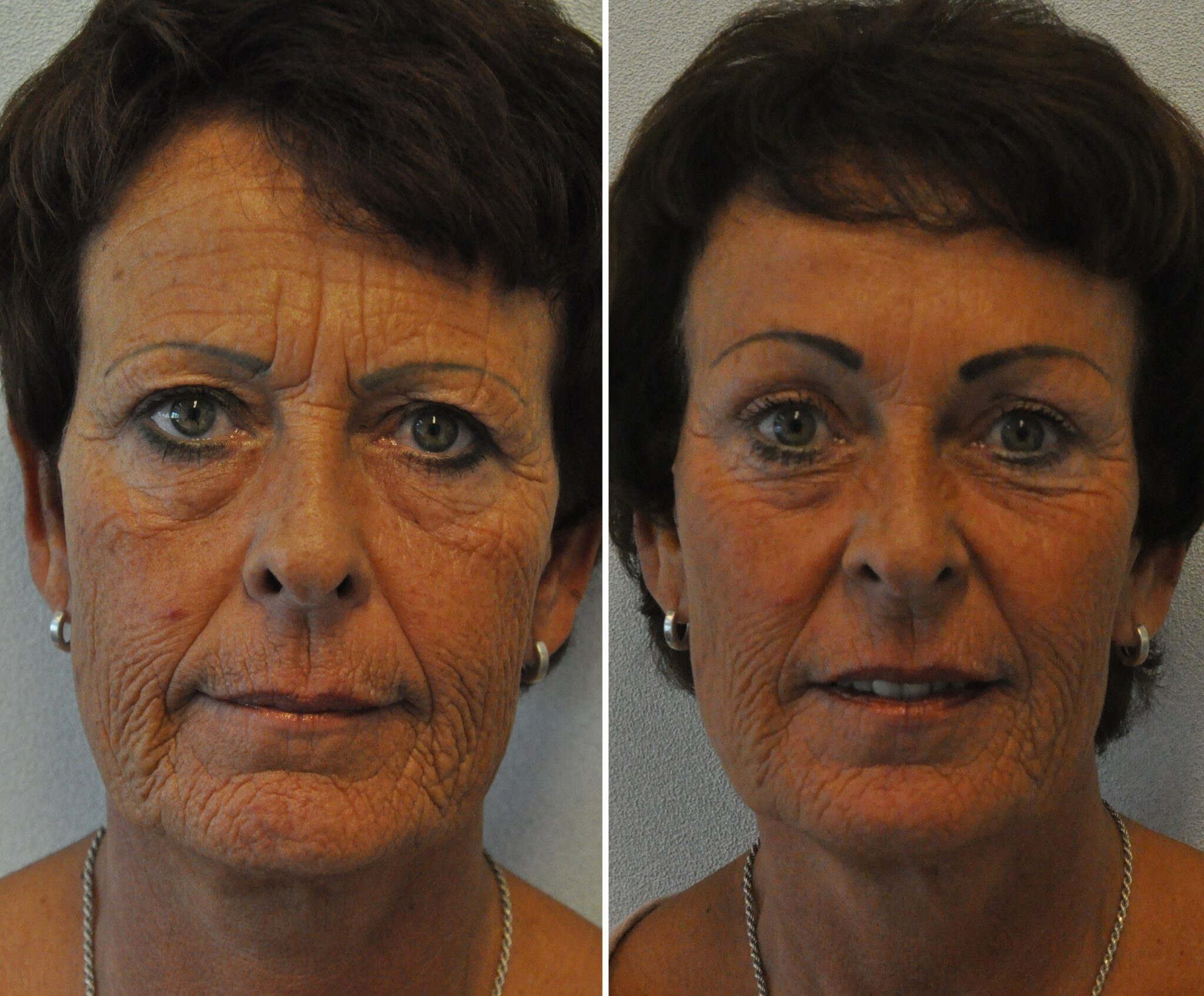 Forehead lift behandeling door Blooming